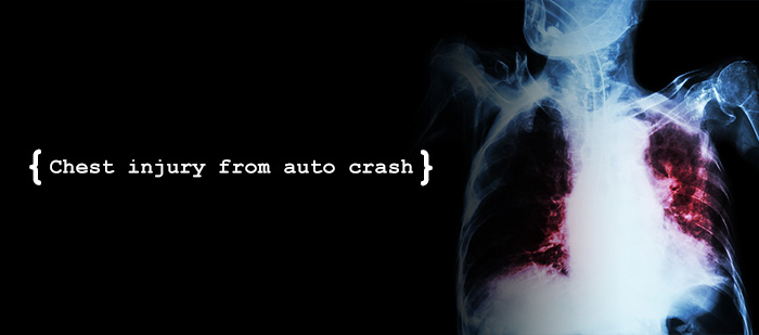 Auto Collisions and Chest Injuries
